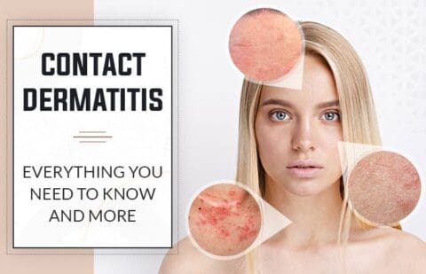 Contact Dermatitis: Everything You Need to Know and More | Winston ...