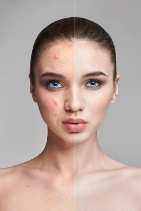 Acne Scars & Large Pores Explained: Similarities, Differences, Causes ...