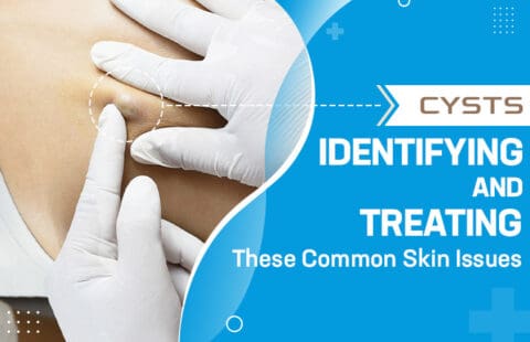 Cysts: Identifying and Treating These Common Skin Issues | Winston ...