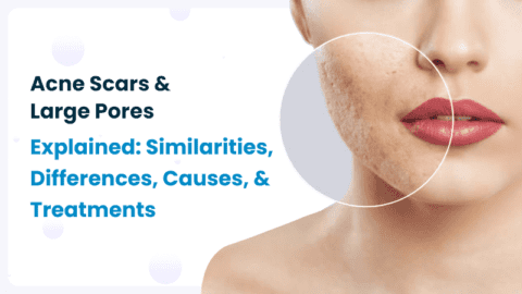 Acne Scars & Large Pores Explained: Similarities, Differences, Causes ...