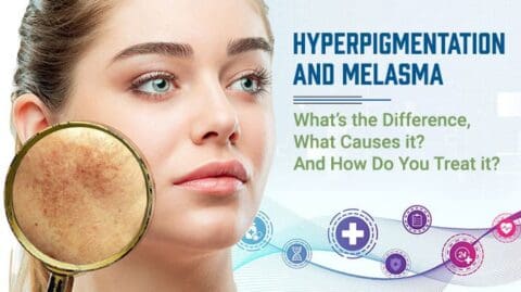 Hyperpigmentation and Melasma: What’s the Difference, What Causes it ...