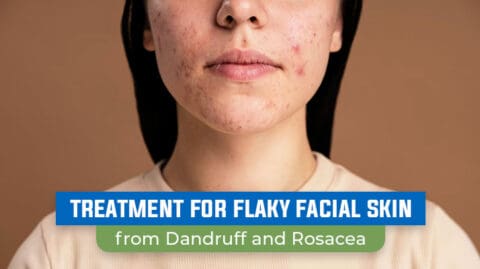 Treatment for Flaky Facial Skin from Dandruff and Rosacea | Winston ...
